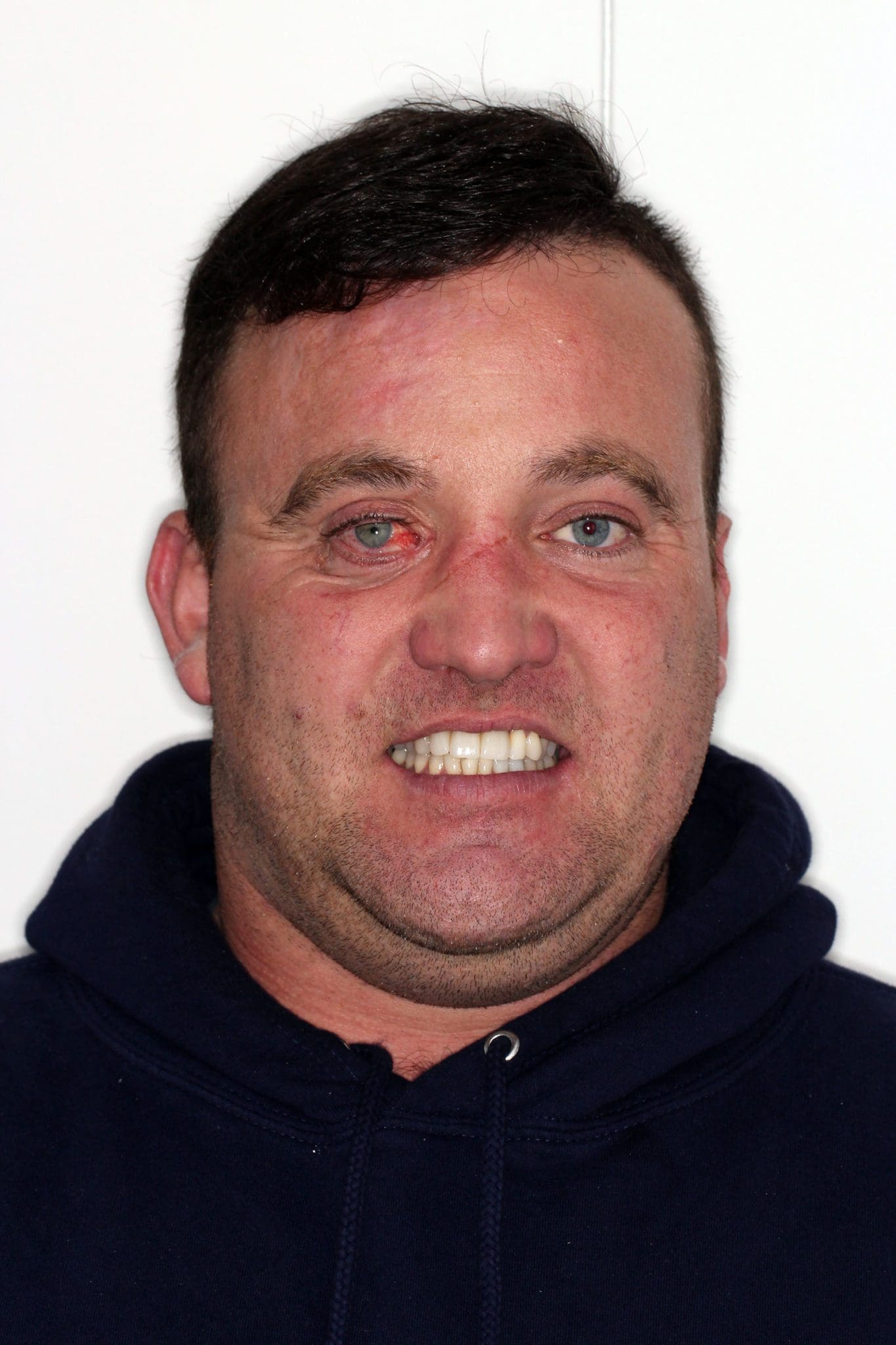 Patient Stories - Implants | Wadebridge Dental Care